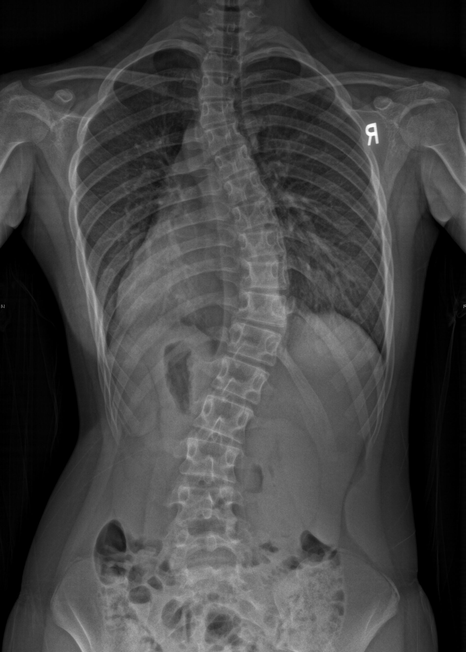 Examination and Diagnosis – Scoliosis Knowledge Hub