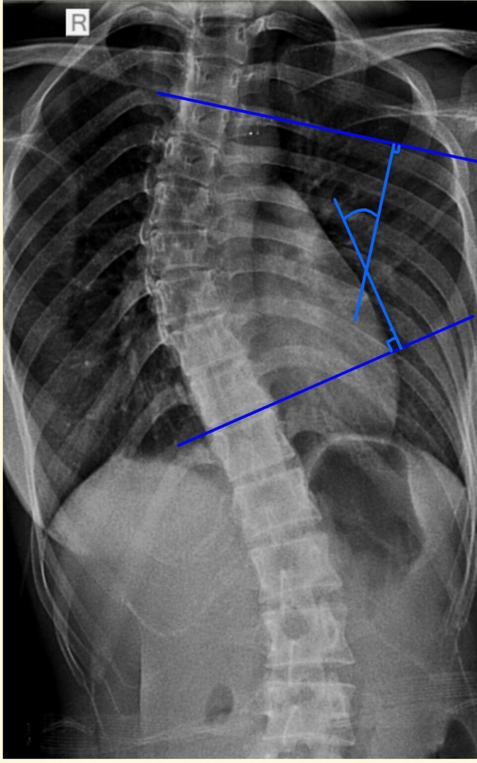 Adolescent Idiopathic scoliosis – Scoliosis Knowledge Hub