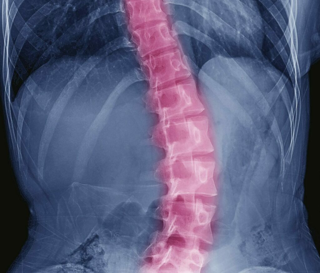 Scoliosis Knowledge Hub – Knowledge about idiopathic scoliosis